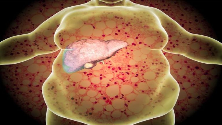 Hígado graso: Síntomas, Tipos, Causas y Tratamiento natural. – HogarIdeal